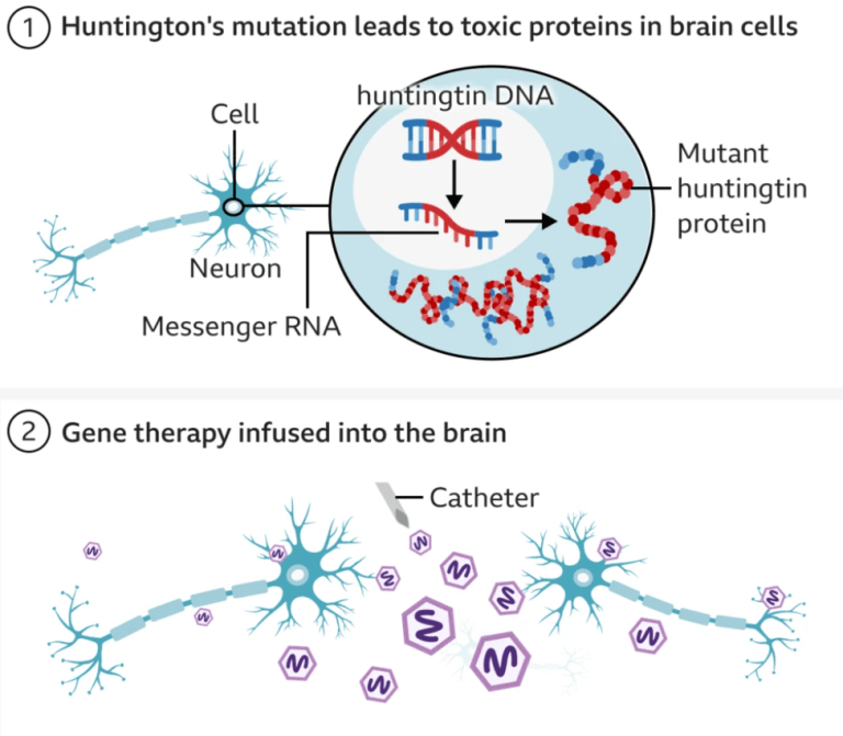 A Historic Breakthrough in Huntington’s disease: Gene Therapy Slows ...