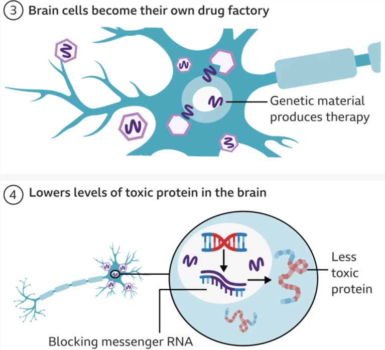 A Historic Breakthrough in Huntington’s disease: Gene Therapy Slows ...